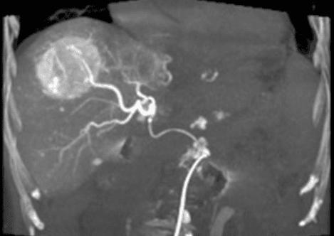 Chemoembolization, Ablation, And Other Liver Cancer Treatments | The ...